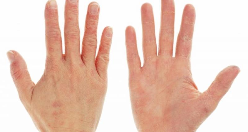 Mare ATENȚIE! Ai mâinile roșii, te mănâncă și te ustură? Organismul te ...