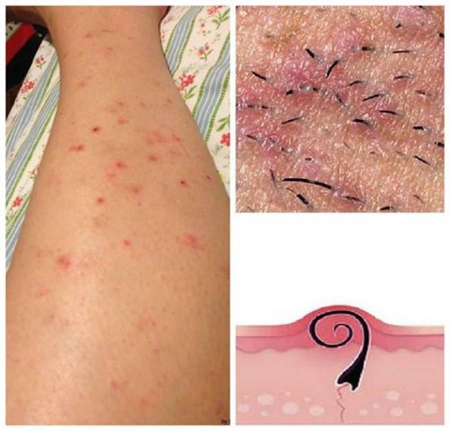 Cum să faci să nu mai ai fire de păr sub piele! Metode simple care te ...