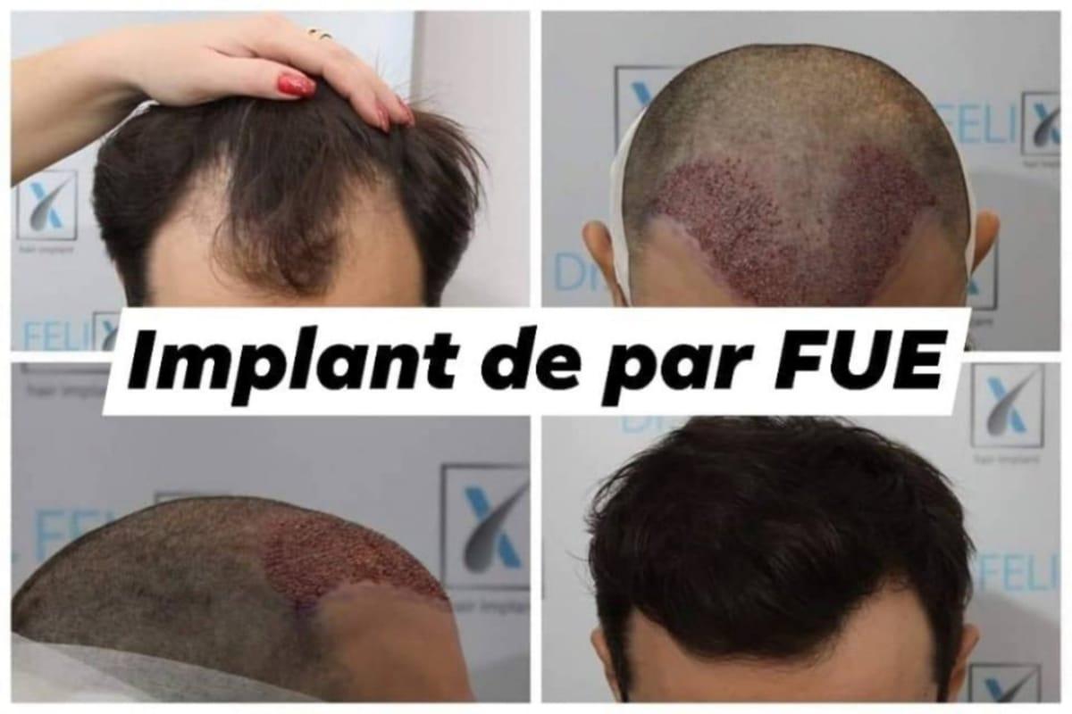 (P) Ce vedete au făcut transplant de păr la clinica Dr. Felix Hair ...